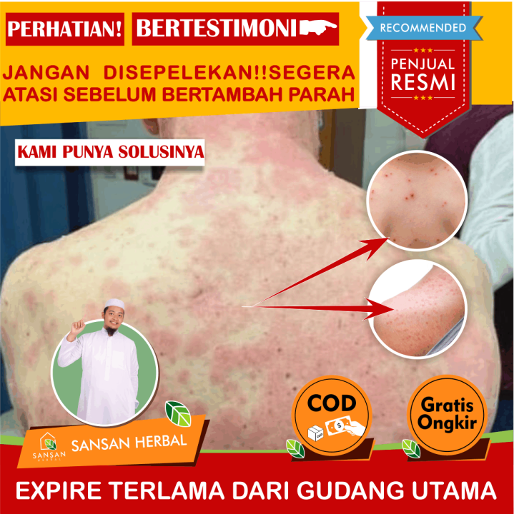 Salep Gatal Ruam, Salep Untuk Ruam Kulit Bayi, Obat Ruam Kulit ...