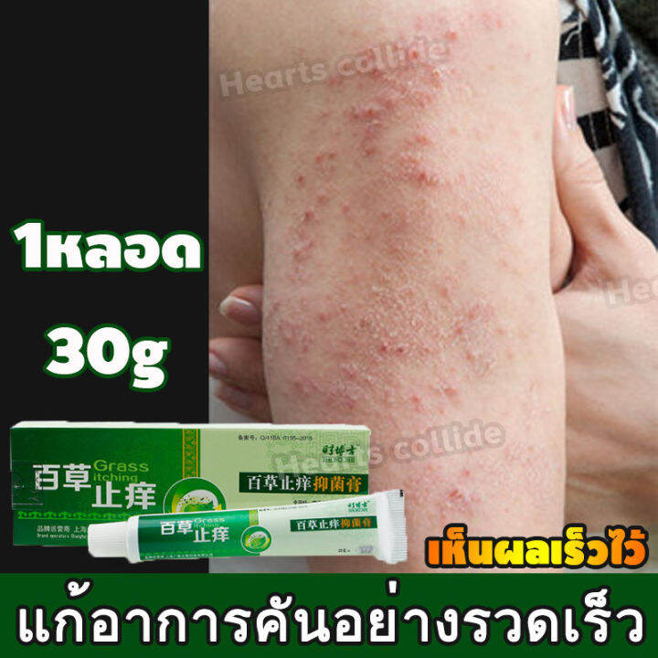 การอัพเกรดใหม่ GRASS ITCHING ครีมคัน แก้กลากสะเก็ดเงินสะเก็ดเงิน สูต ...