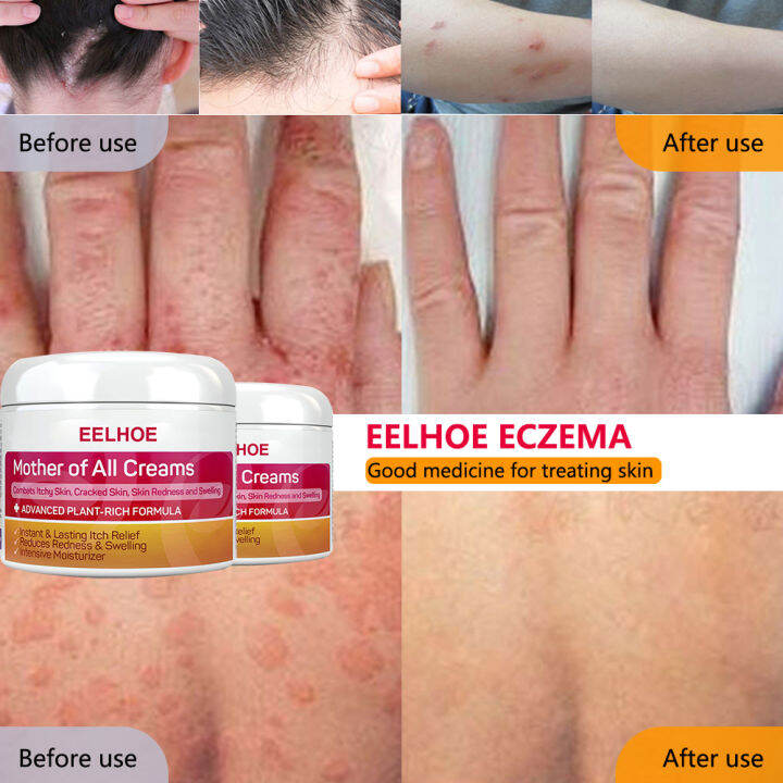 Erya EELHOE Eczema Treatment Cream gamot sa kati kati sa balat buni ...