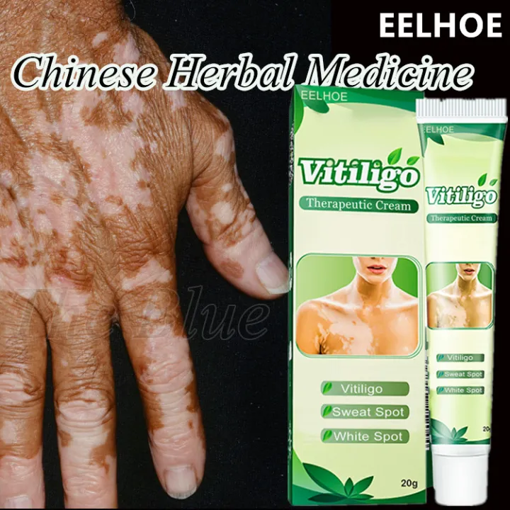 EELHOE Vitiligo cream Leukoplakia Disease Chinese Herbal Medicine ...