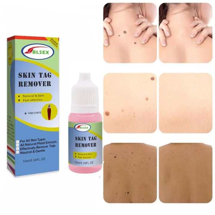 [READY STOCK] Skin Tag Wart Remover Fast Acting Wart Remover Plantar ...