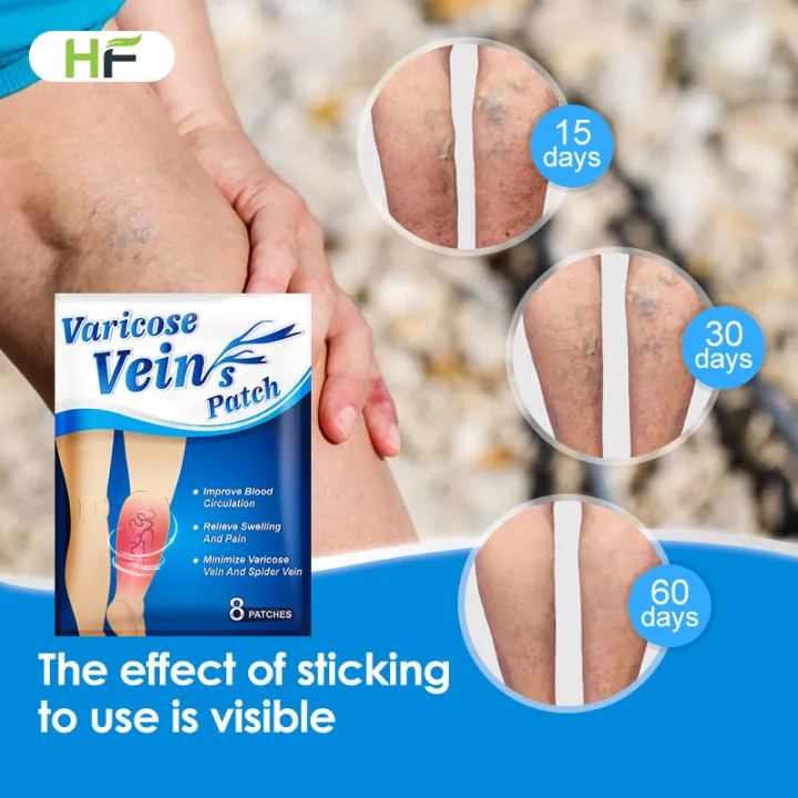 Varicose Veins Patch Relief Phlebitis Angiitis Remedy Pain Relief Patch ...