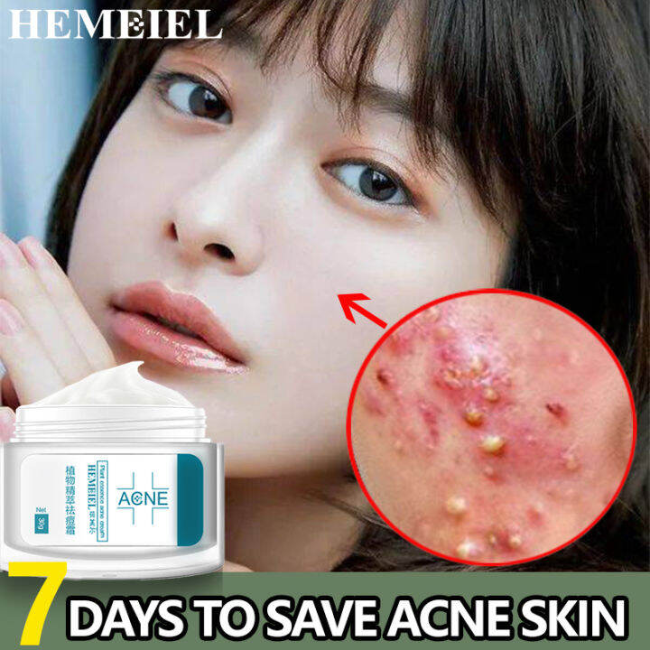 HEMEIEL Pimple Marks Remover/Pimple Eraser Quick Fx/Pimples Acne ...