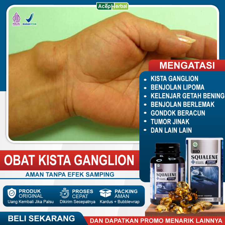 Obat Benjolan di tangan, Kista Ganglion, Obat Benjolan di Pergelangan ...