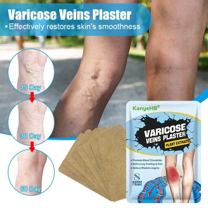 KANYEHB Varicose veins remover cream plaster patch pain relief ...