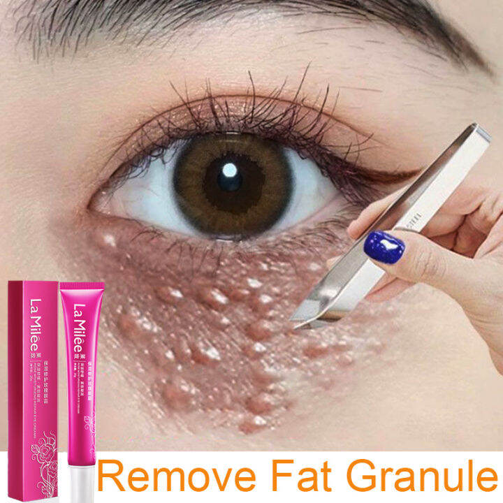 Eye Essence Cream Fat Particles Remover Sweat Duct Tumor Eye Special ...