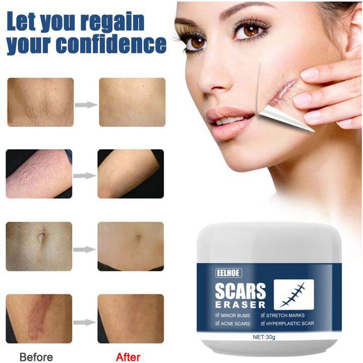 EELHOE SCARS ERASER ACNE SCARS | Lazada PH