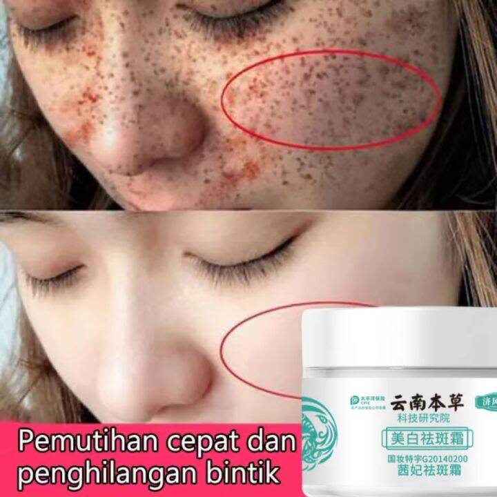 Melasma Cream Yunnan Herbal Whitening Freckle Cream Dark Spots on Face ...