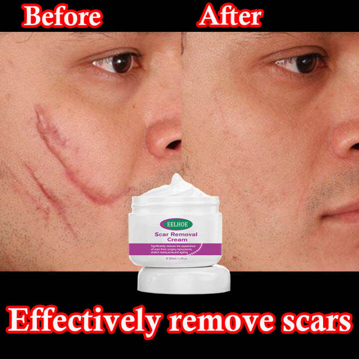 Scar Remover Cream For Old Scar On Legs Acne Scar Remover Peklat ...