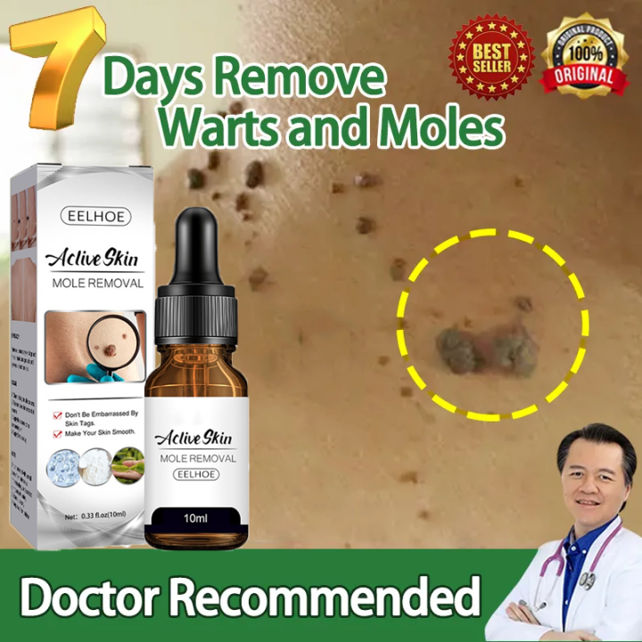 Remove Warts & Moles Nature's Miracle Original Organic Pure Kaso Oil ...