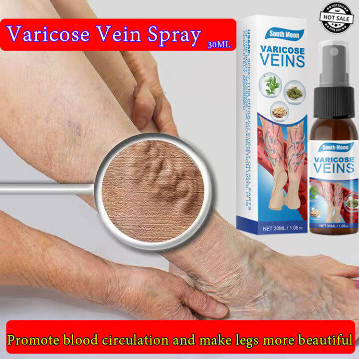 Original South Moon varicose veins remover 30 ML,Effective removal ...