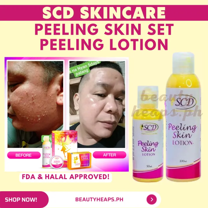 SCD Peeling Skin Set | Peeling Skin Lotion for Melasma Pekas Dark Areas ...