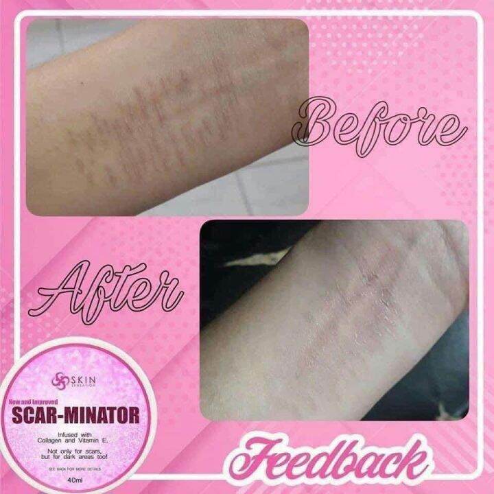 Scarminator Cream By Skin Sensation 40ml Peklat Pekas Stretchmark