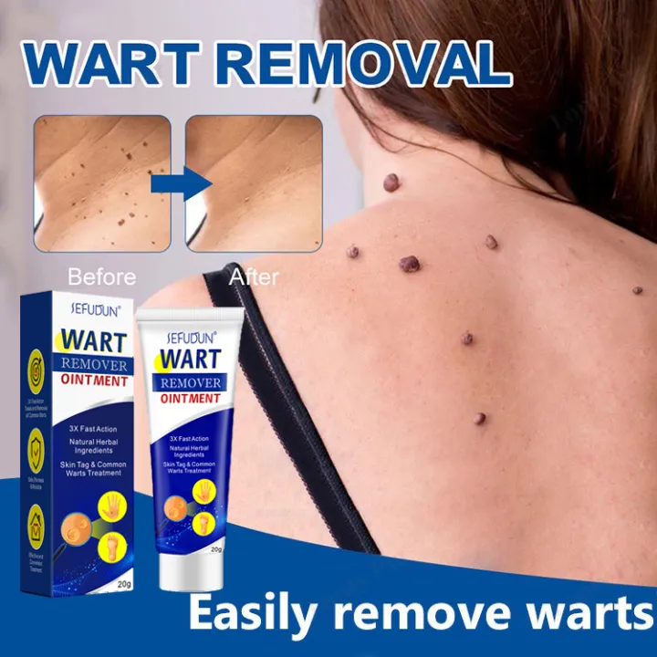 Warts Remover Original Cream Warts Magic Remover Ointment Wart Removal ...