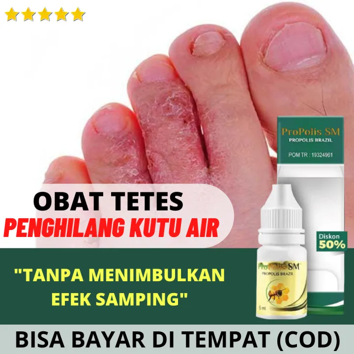 Obat Salep Oles Kutu Air - Obat Atasi Kutu Air Gatal Gatel Parah Di ...