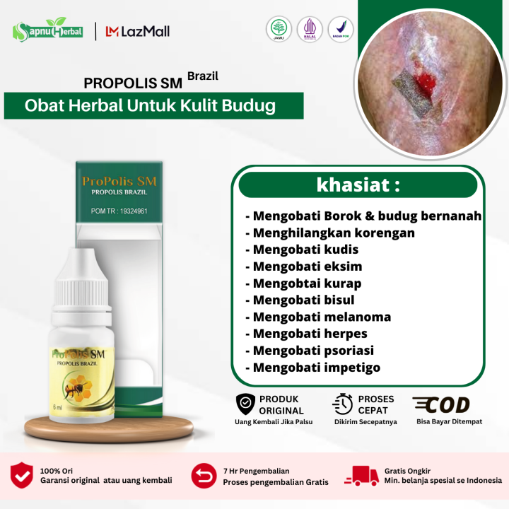 Obat Oles Budug di Kaki Bernanah, Penghilang Koreng Bekas Budug, Borok ...