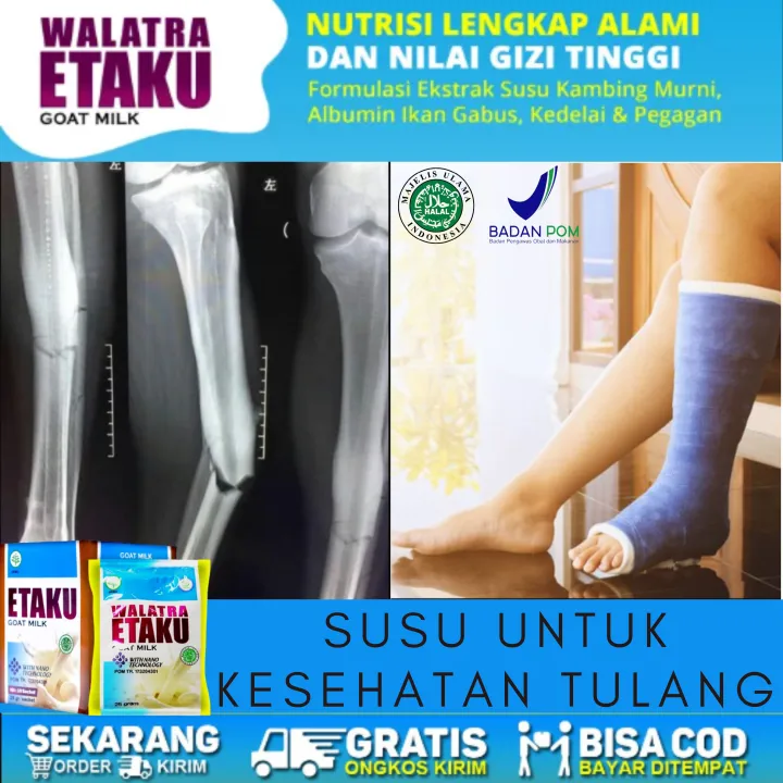 Obat Patah Tulang Kaki, Keropos, Retak, Remuk, Pengapuran tulang ...