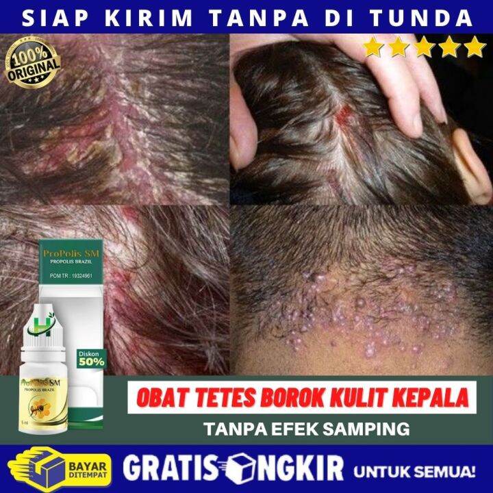 Obat Tetes Herbal Dermatitis Seboroik - Obat Borok Di Kepala Untuk Anak ...