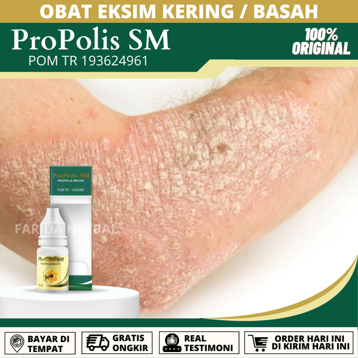 Obat Eksim Kering Menahun, Eksim Basah, Salep Eksim, Gatal Kulit Eksim, Eksim Parah, Gatal Eksim ...