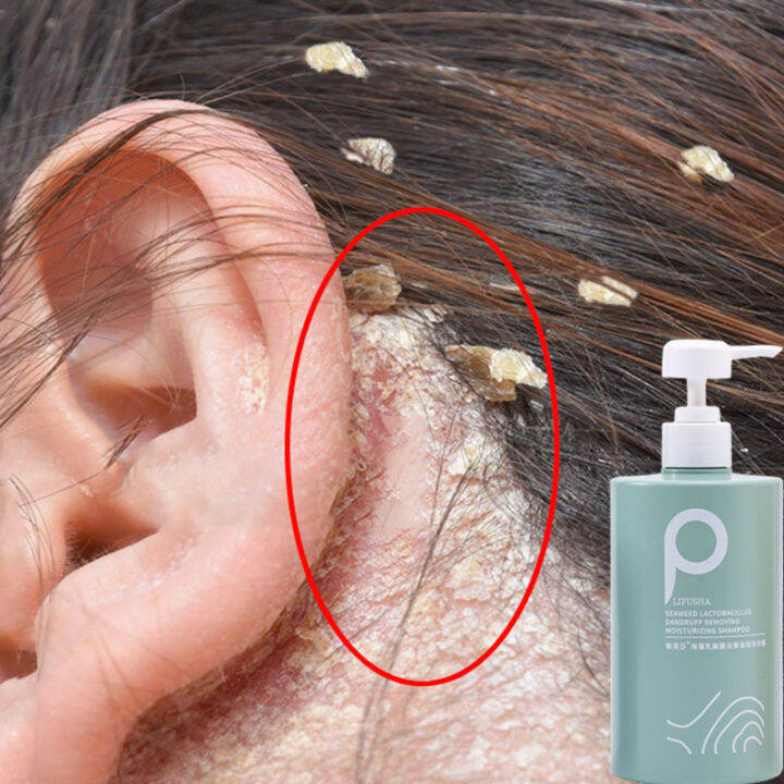 Sampo anti ketombe dan gatal 500ml Pengobatan folikulitis dan psoriasis ...