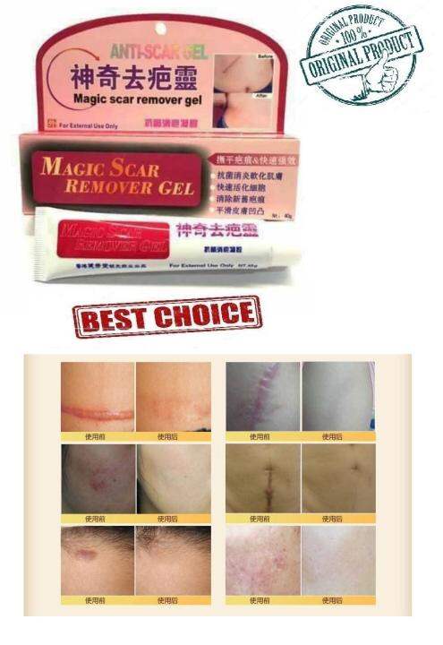 Magic Scar Remover Gel 40g - 1PC | Lazada PH