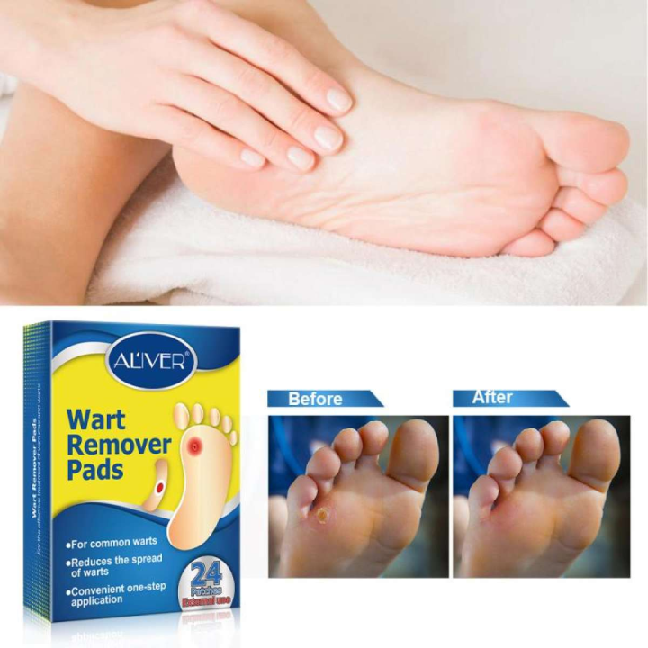 Aliver 24Pcs Feet Corns/ Warts Removal Patch Pain Relief Remover Feet ...