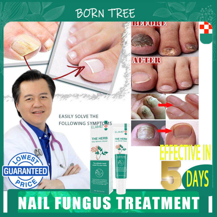 nail treatment fungal anti fungal for nails repair treatment cream gel ...