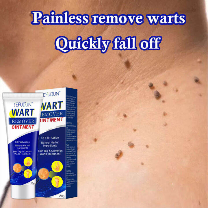 Warts Remover Original Cream 20g painless Warts Magic Remover Wart ...