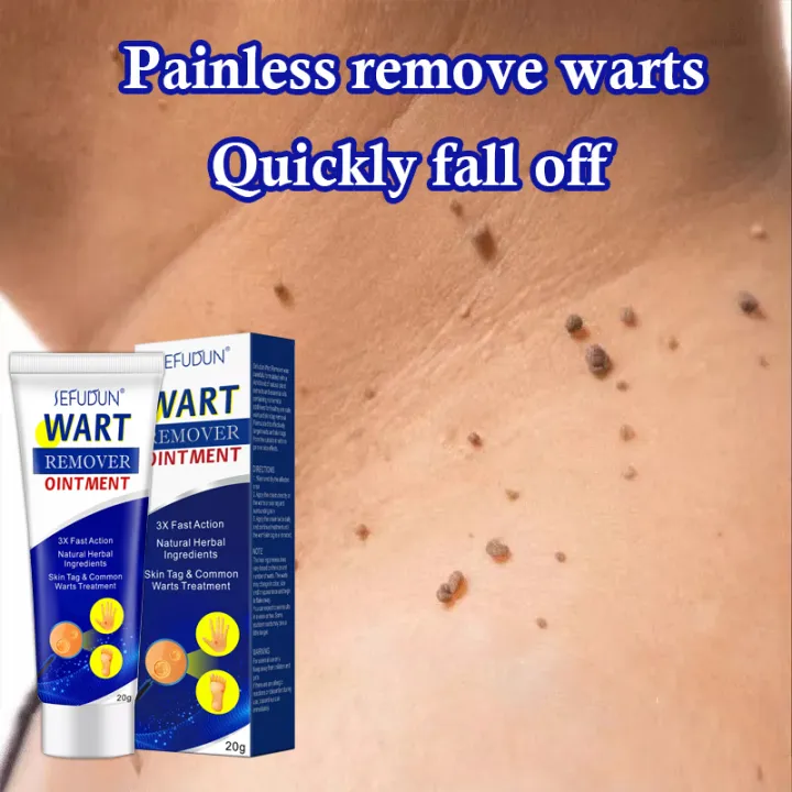 Warts Remover Original Cream 20g painless Warts Magic Remover Wart ...
