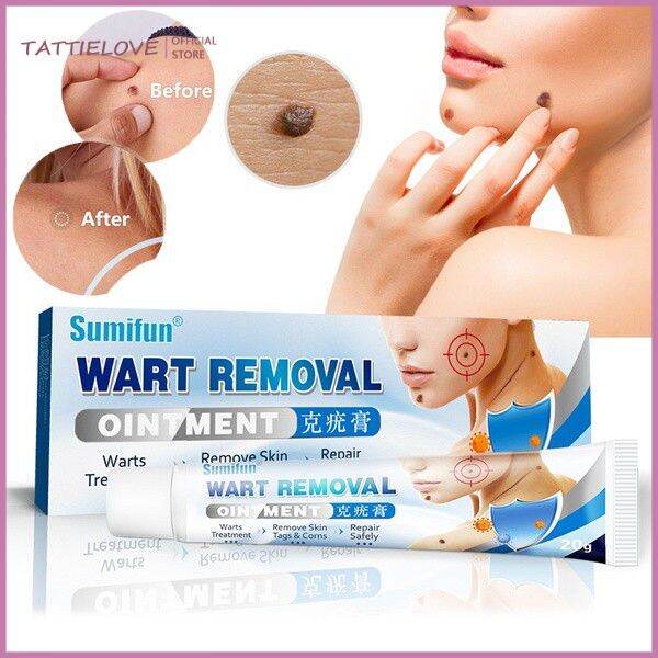 20g wart treat--ment cream anti--bacterial oint--ment skin marks ...