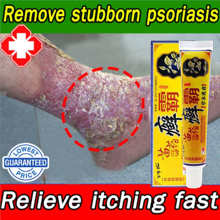 Sumifun Eczema Treatment Cream Atoderma Cream Original Gamot sa kati ...