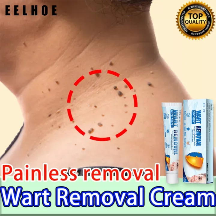 Local delivery【EELHOE】Warts Remover Original Cream Ointment Wart ...