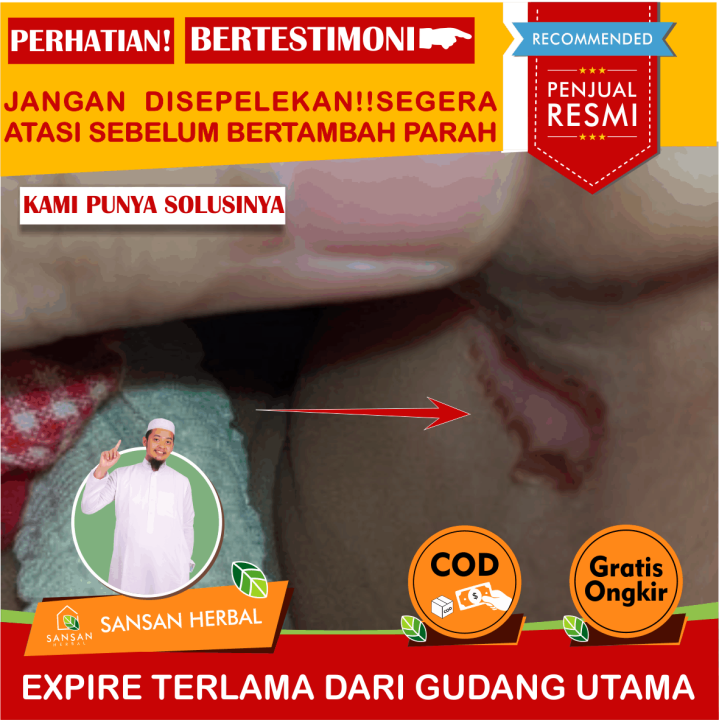 Obat Luka lecet bayi, luka lecet selangkangan, di kemaluan, di ...