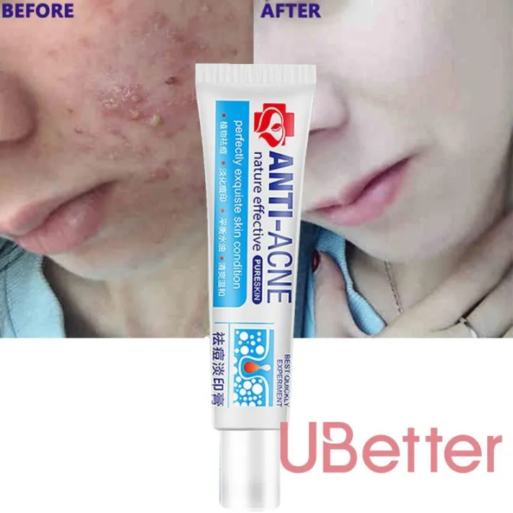 UBetter New Herbal Chinese Medicine Acne Cream Safe&Gentle Remove Acne ...