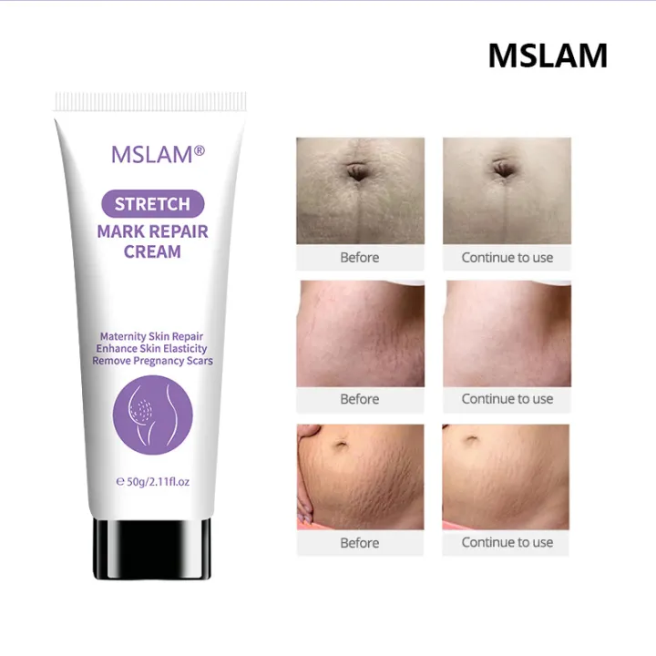 MSLAM Stretch Marks Cream,Pregnancy cream 50g effectively remove ...