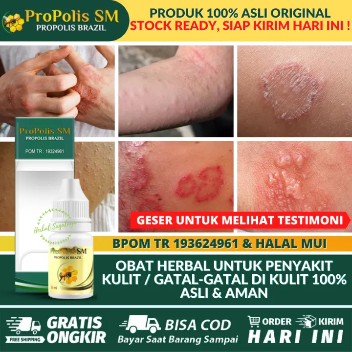 Obat Scabies / Skabies - Obat Kudis Budug Gudig Budukan - Obat Kutu ...