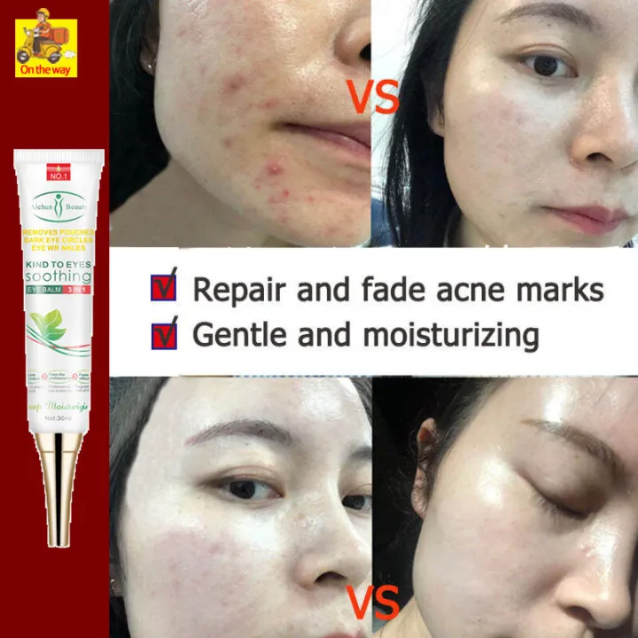 【COD】Buy 2 Take 1🔥Acne cream，pimple marks remover，pimple remover，Reduce ...