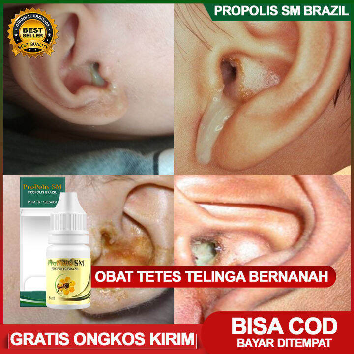 Obat Telinga Berair, Bernanah Dan Bau, Telinga Keluar Cairan, Radang ...
