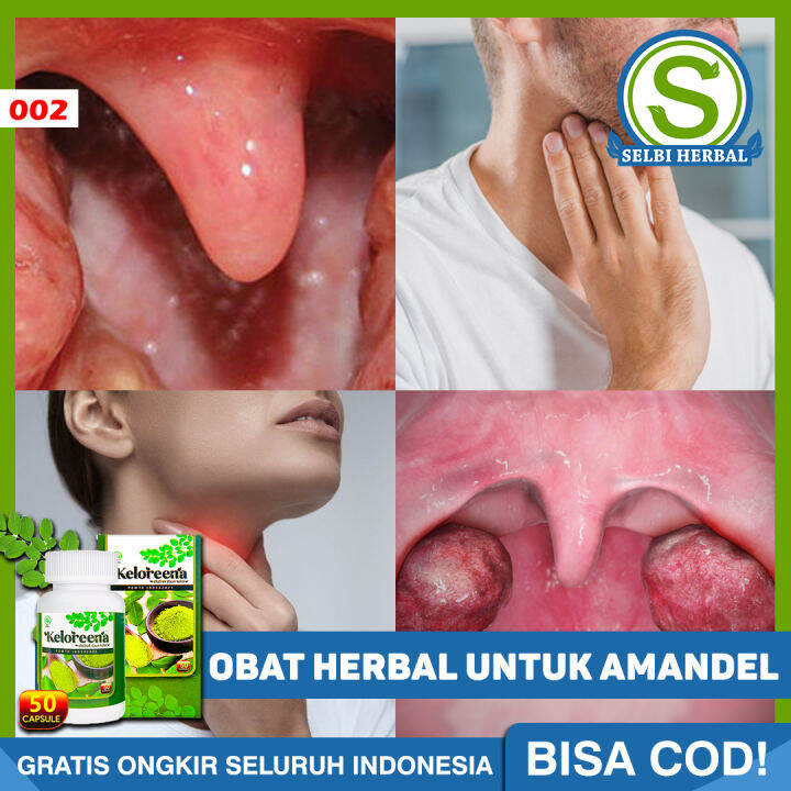 Keloreena - Obat Herbal Untuk Amandel - Bengkak dan Berdarah ...