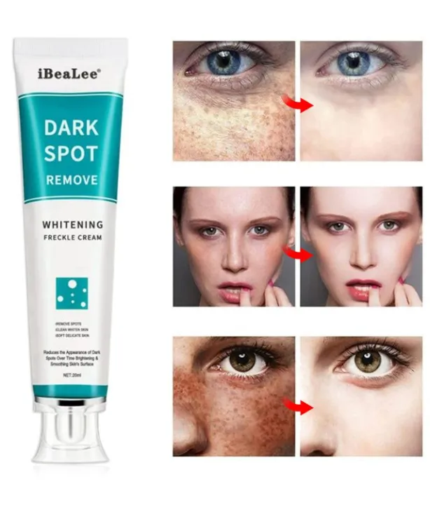 GORICH Whitening Freckle Cream Lightening Pigmentation Mild Freckles ...