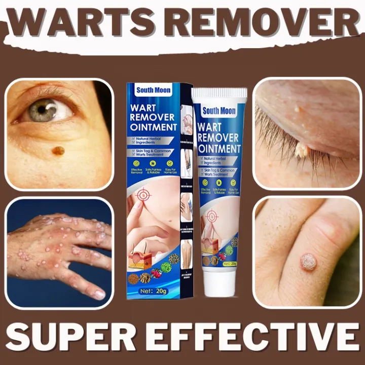 Effective Warts Remover Original Skin Tag Remover Organic Mole Warts Remover Cream Warts Removal ...