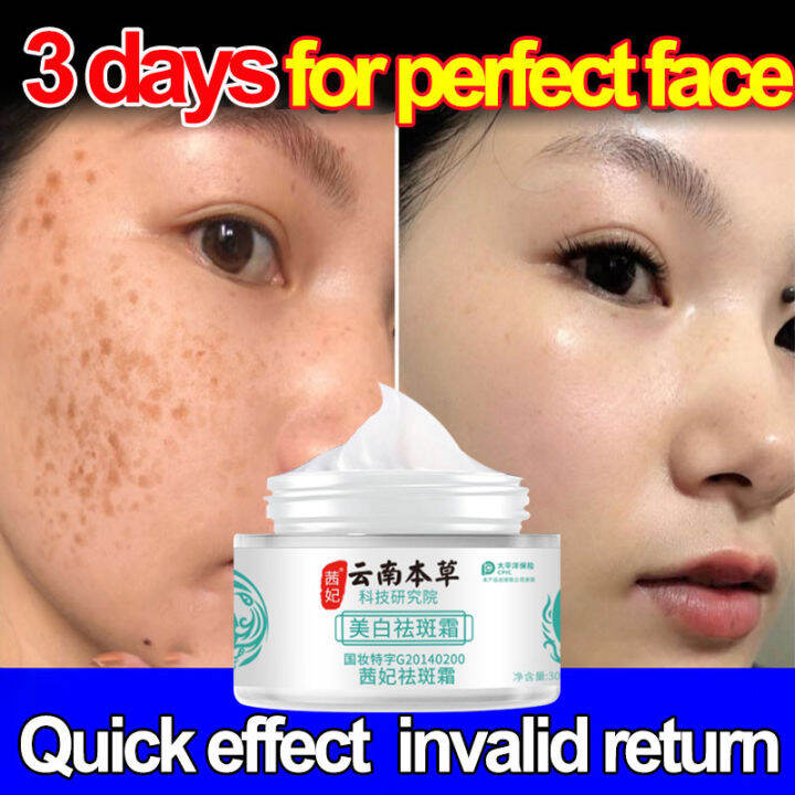 Japanese Melasma Cream Yunnan Herbal Whitening Freckle Cream Japanese ...
