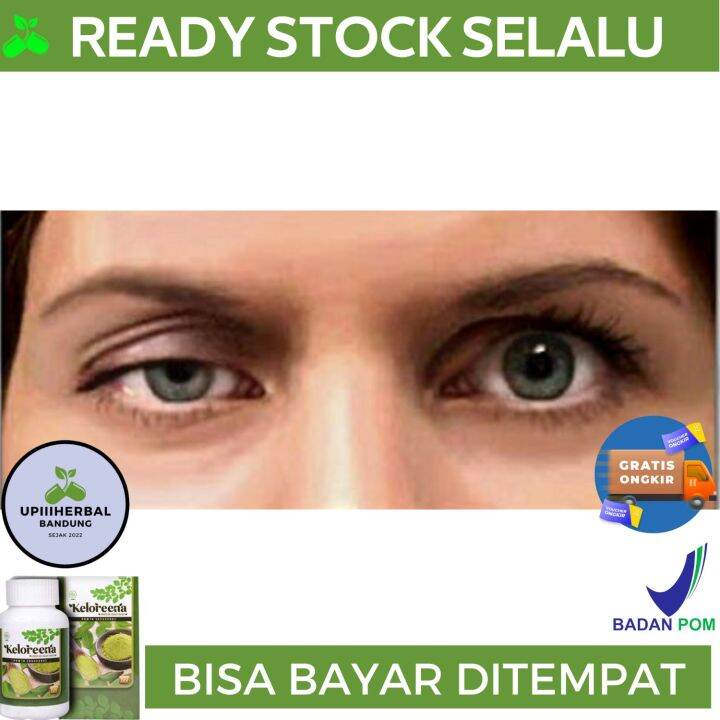 Obat Saraf Mata Lemah, Obat Untuk Saraf Mata Lemah, Obat Strabismus ...
