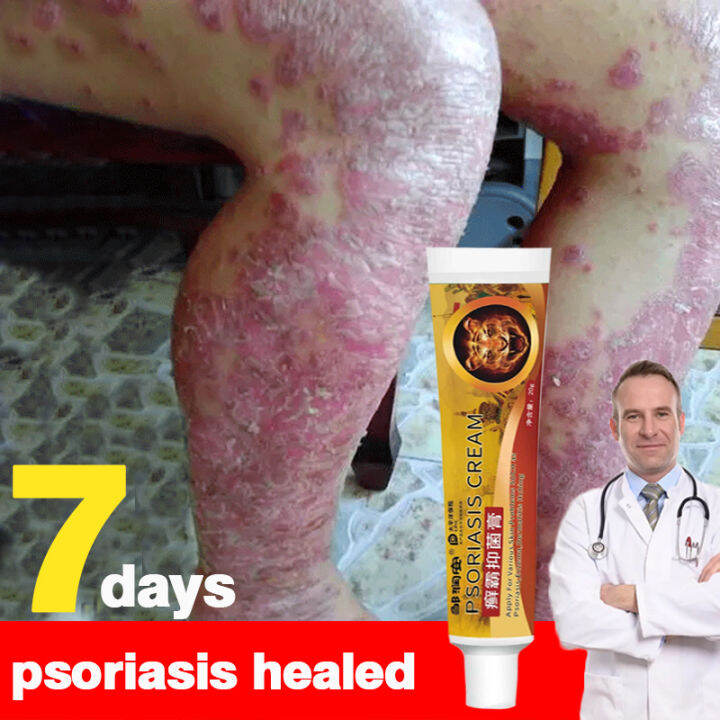 🔥100% Effective🔥Herbal Psoriasis Eczema antibacterial cream Safe Plant ...