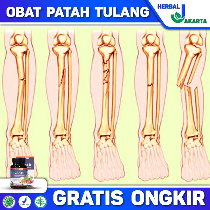 Obat Patah Tulang, Herbal Patah Tulang, Patah Tulang Untuk Tangan ...