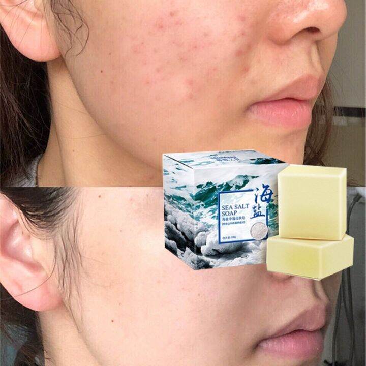 Sea Salt Soap Removal Pimple Pores Acne Treatment Cleaner Moisturizing ...