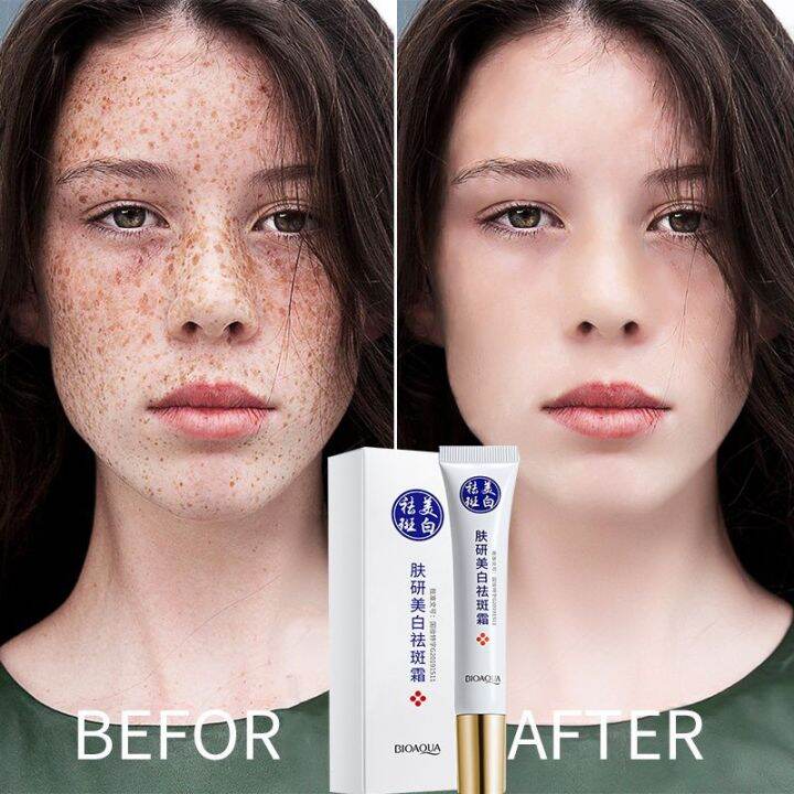 pekas remover cream , Whitening freckle , pekas remover effective ...