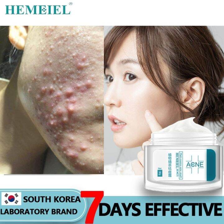 HEMEIEL Back Acne Treatment/Pimple Remover Cream/Benzac Benzoyl ...