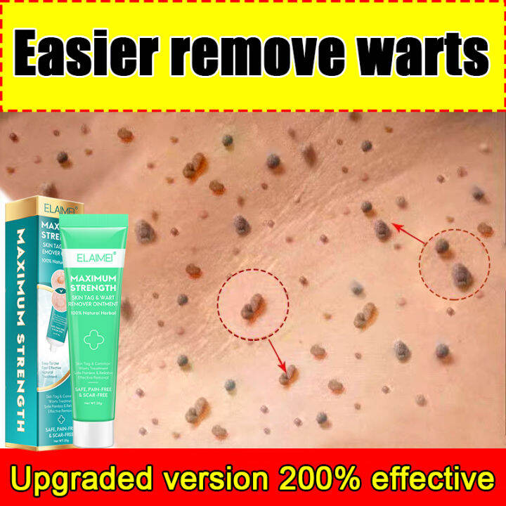 200% effective ELAIMEI Warts Remover Original Cream 20g Warts Magic ...