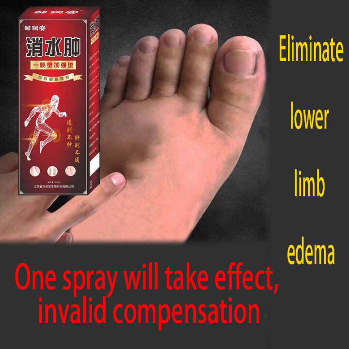 Edema removing spray for Neck Shoulder Waist Leg Joint Edema Anti-edema ...